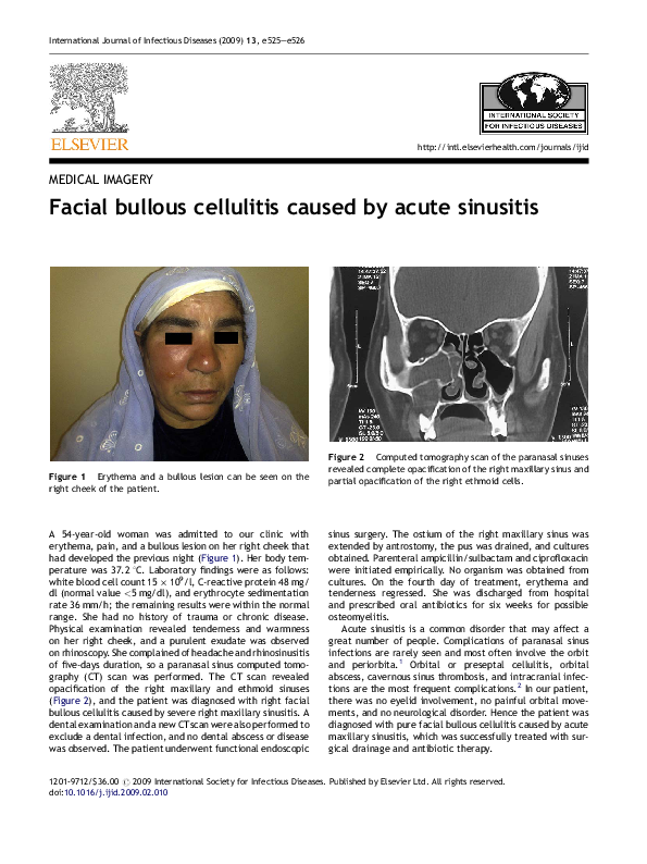 (PDF) Facial bullous cellulitis caused by acute sinusitis