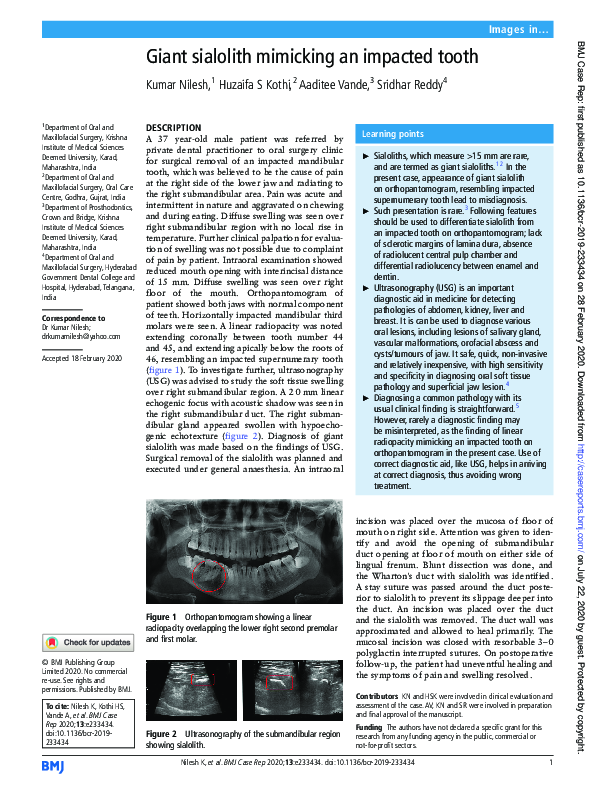 (PDF) Giant sialolith mimicking an impacted tooth