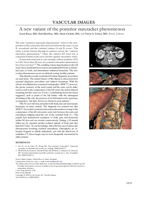 (PDF) A new variant of the posterior nutcracker phenomenon | Ziad ...