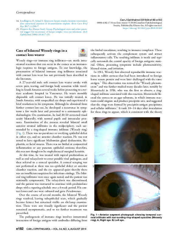 (PDF) Case of bilateral Wessely rings in a contact lens wearer