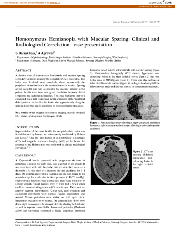 (PDF) Homonymous Hemianopia with Macular Sparing: Clinical and ...
