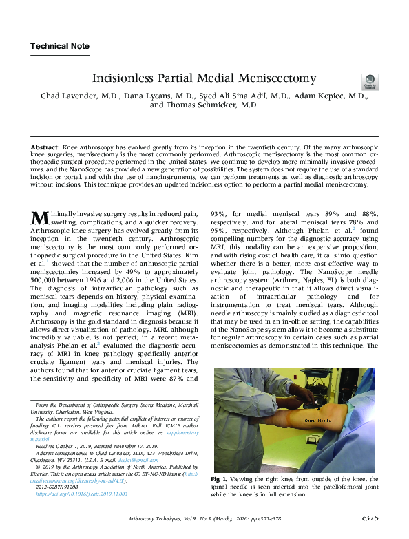 (PDF) Incisionless Partial Medial Meniscectomy | Adam Kopiec - Academia.edu