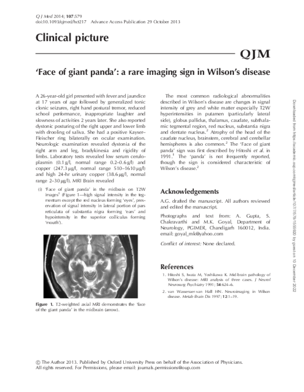 (PDF) Face of giant panda': a rare imaging sign in Wilson's disease