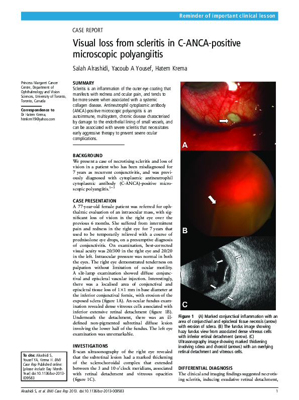(PDF) Visual loss from scleritis in C-ANCA-positive microscopic ...