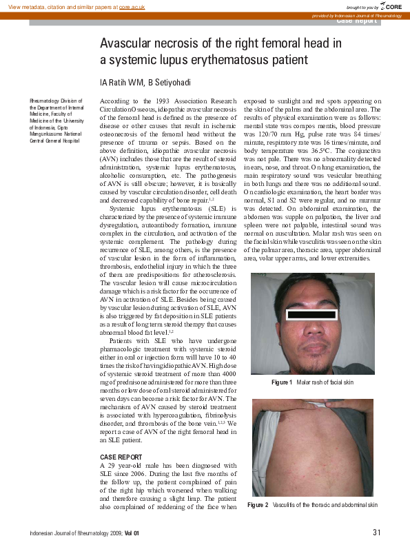 (PDF) Avascular necrosis of the right femoral head in a systemic lupus ...