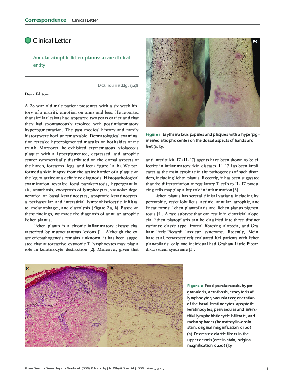 (PDF) Annular atrophic lichen planus: a rare clinical entity | Reyhan ...