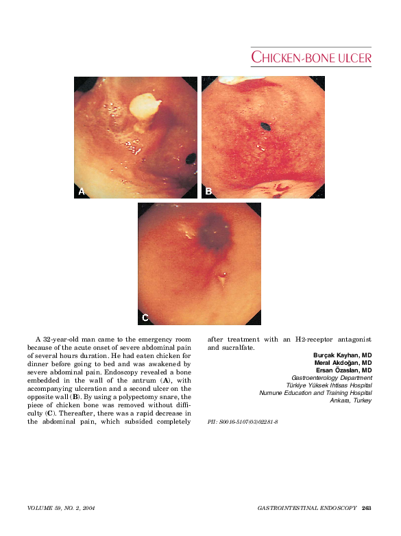 (PDF) Chicken-bone ulcer