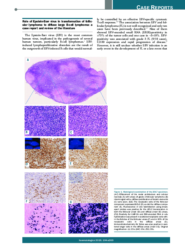 (PDF) Role of Epstein-Barr virus in transformation of follicular lymphoma to diffuse large B ...