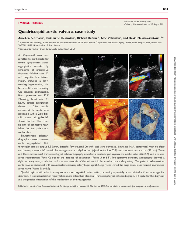 (PDF) Quadricuspid aortic valve: a case study