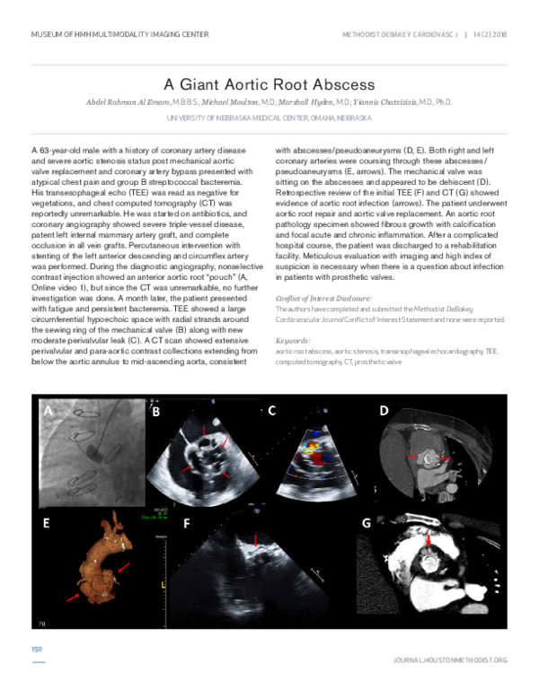 (PDF) A Giant Aortic Root Abscess