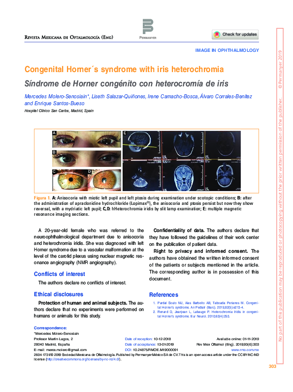 (PDF) Congenital Horner´s syndrome with iris heterochromia | Liseth ...