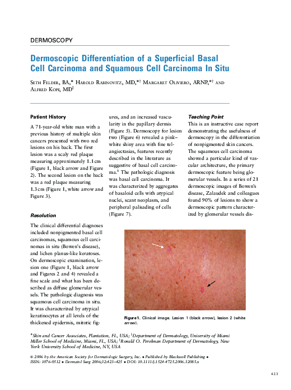 (PDF) Dermoscopic Differentiation of a Superficial Basal Cell Carcinoma ...
