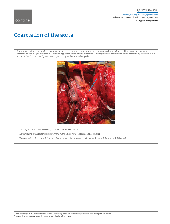 (PDF) Coarctation of the aorta