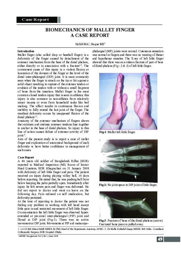 (PDF) Biomechanics of Mallet Finger - A Case Report