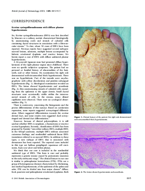 (PDF) Pustular vasculitis in a patient with T-cell large granular ...