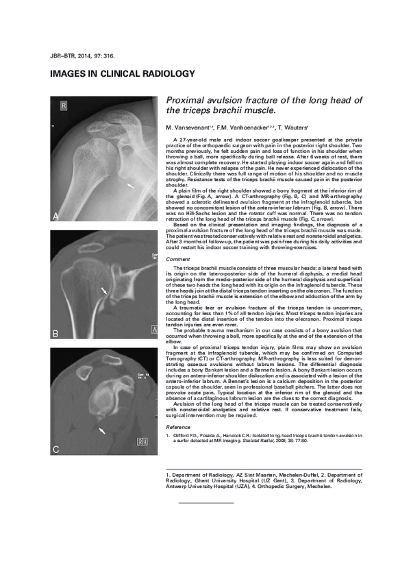 (PDF) Proximal avulsion fracture of the long head of the triceps ...