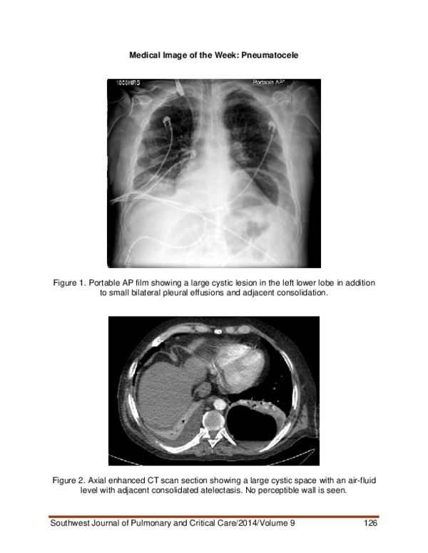 (PDF) Medical image of the week: pneumatocele