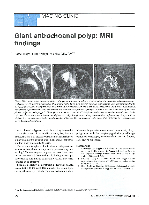 (PDF) Giant Antrochoanal Polyp: MRI Findings