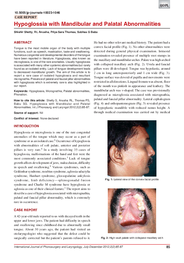 (PDF) Hypoglossia with Mandibular and Palatal Abnormalities