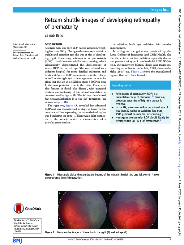 (PDF) Retcam shuttle images of developing retinopathy of prematurity ...