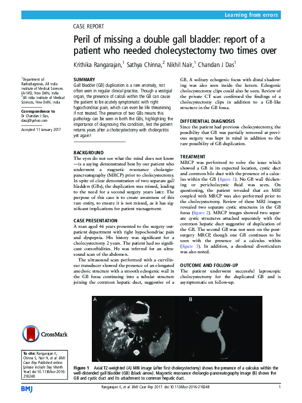 (PDF) Peril of missing a double gall bladder: report of a patient who ...