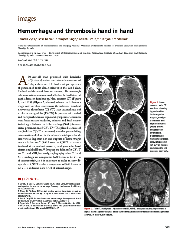 (PDF) Hemorrhage and thrombosis hand in hand