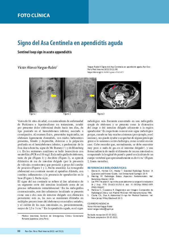 (PDF) Signo del Asa Centinela en apendicitis aguda