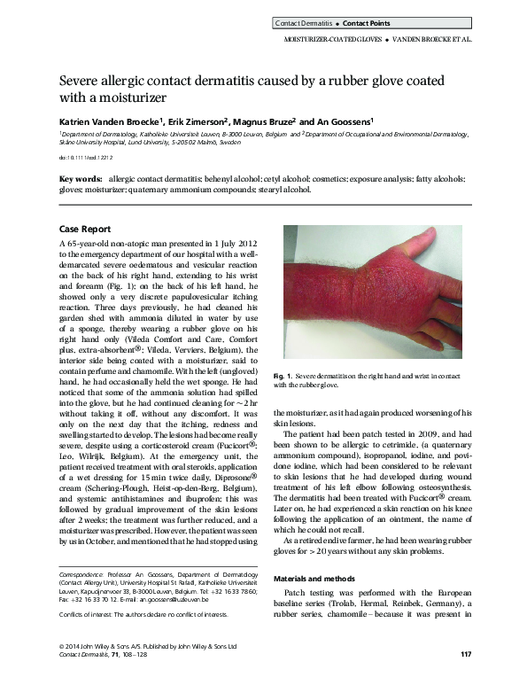 (PDF) Severe allergic contact dermatitis caused by a rubber glove ...