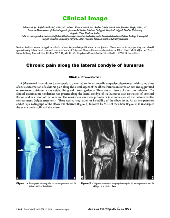 (PDF) Chronic pain along the lateral condyle of humerus