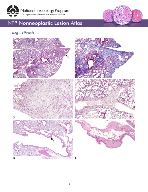 (PDF) Lung fibrosis