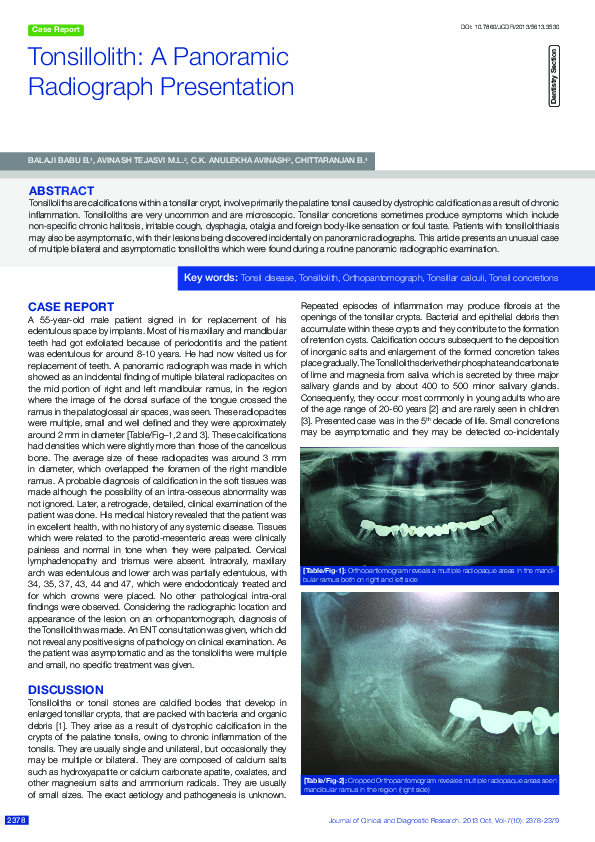 (PDF) Tonsillolith: A Panoramic Radiograph Presentation | Anulekha ...