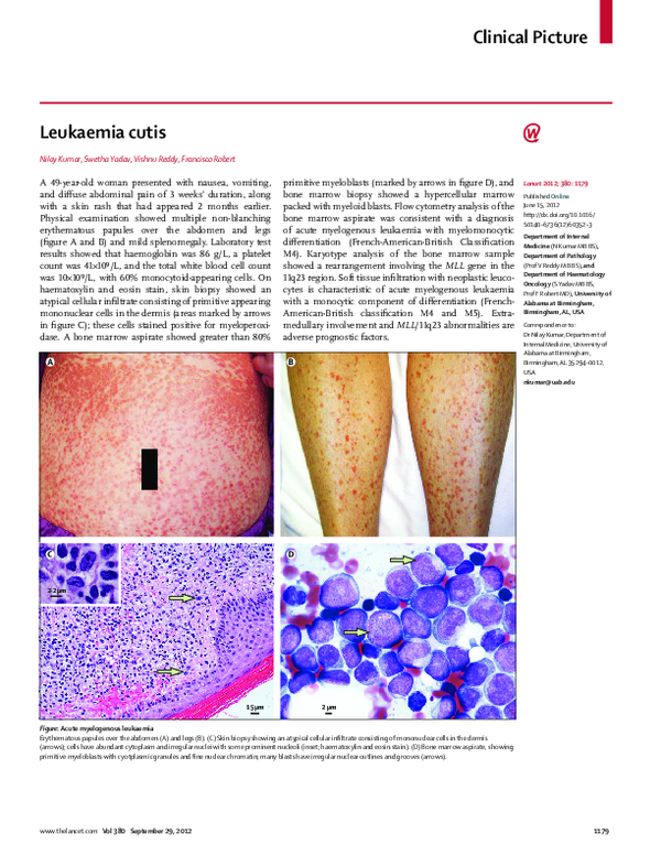 (PDF) Leukaemia cutis