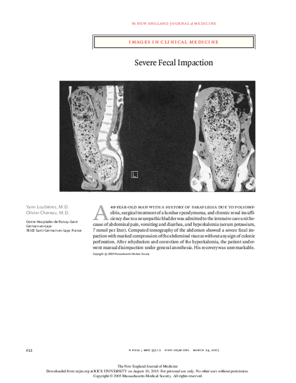 (PDF) Severe Fecal Impaction