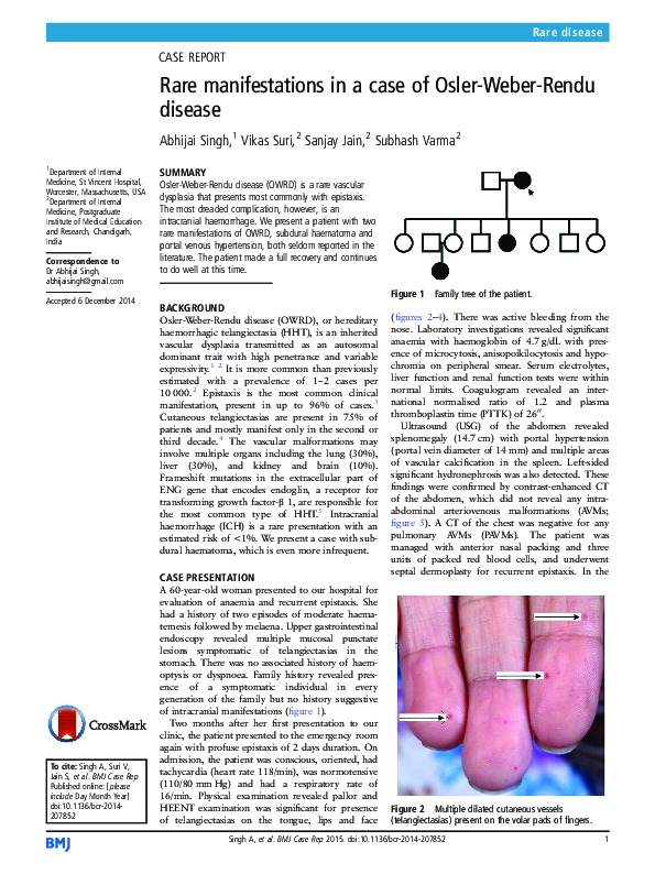 (PDF) Rare manifestations in a case of Osler-Weber-Rendu disease ...
