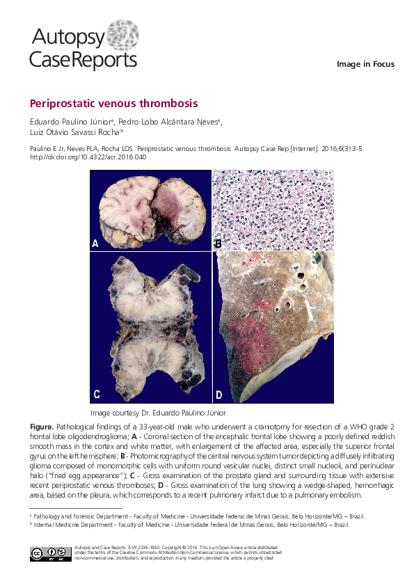 (PDF) Periprostatic venous thrombosis