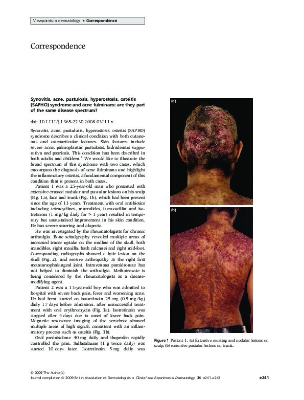 (PDF) Synovitis, acne, pustulosis, hyperostosis, osteitis (SAPHO ...