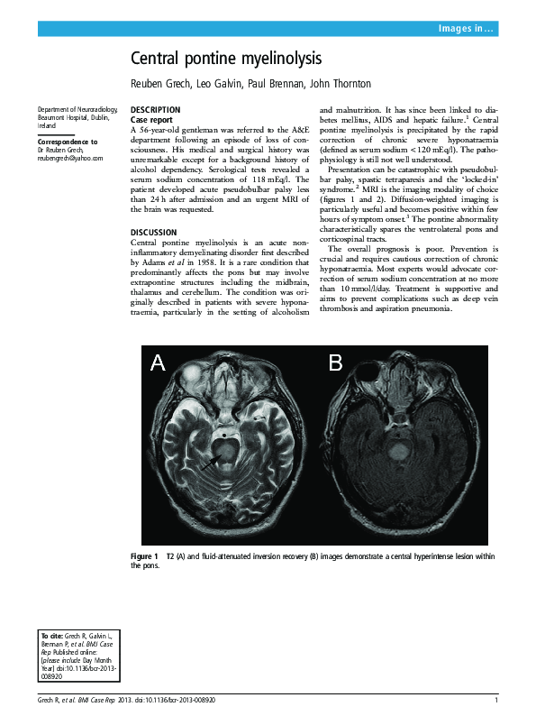 (PDF) Central pontine myelinolysis