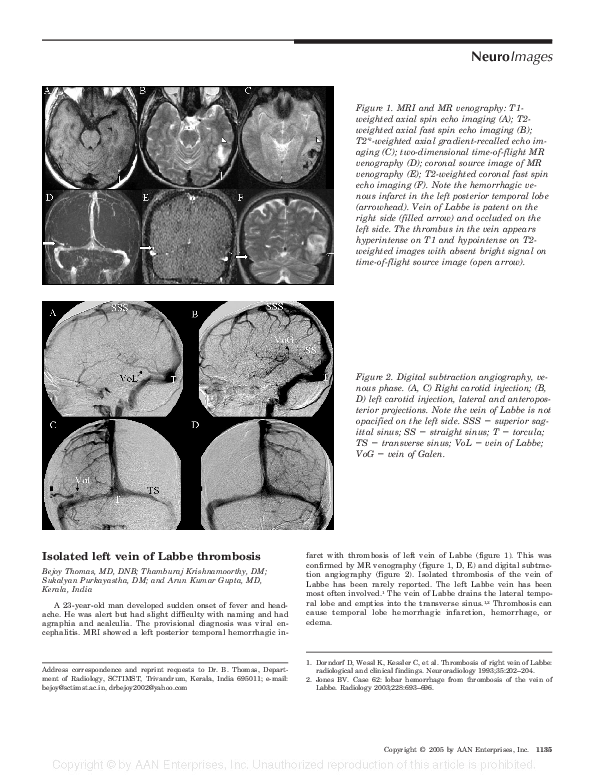 (PDF) Isolated left vein of Labbe thrombosis | DR SURENDRA KHOSYA ...