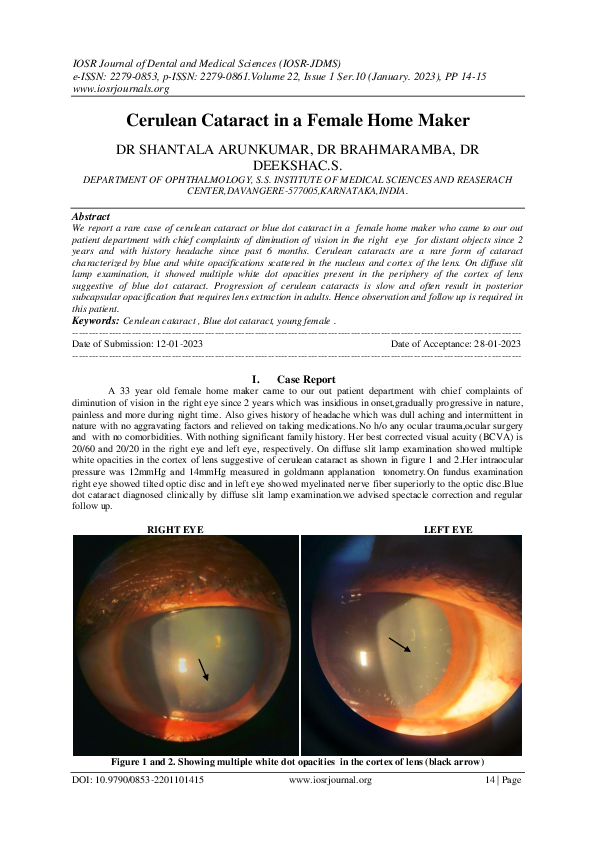 (PDF) Cerulean Cataract in a Female Home Maker