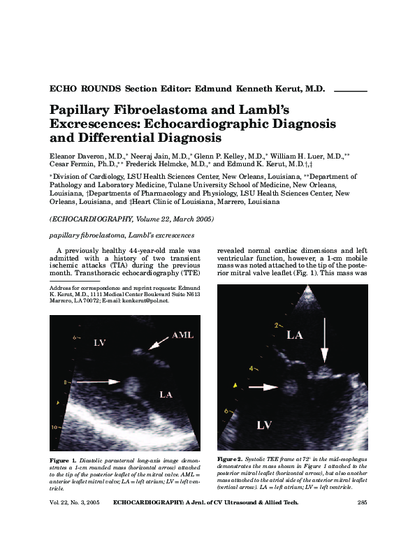 (PDF) Papillary Fibroelastoma and Lambl's Excrescences ...