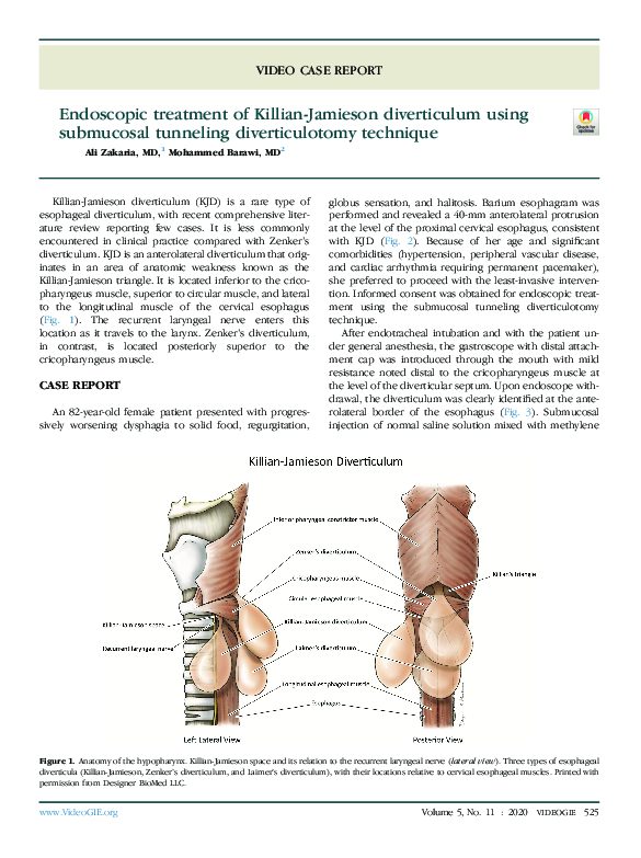 (PDF) Endoscopic treatment of Killian-Jamieson diverticulum using ...