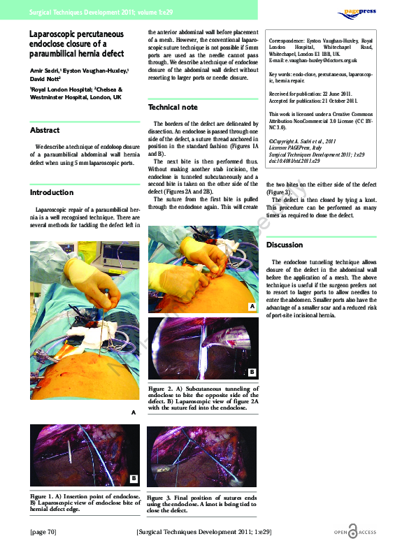 (PDF) Laparoscopic percutaneous endoclose closure of a paraumbilical ...