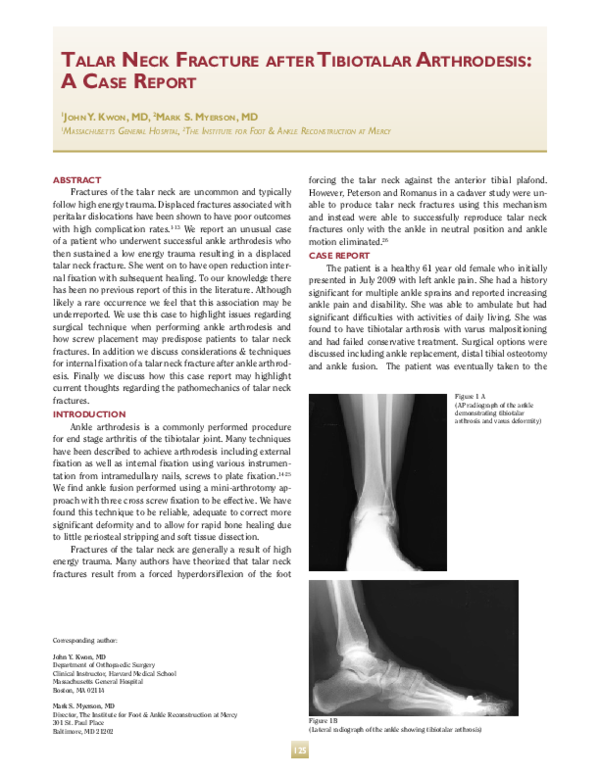 (PDF) Talar Neck Fracture after Tibiotalar Arthrodesis: Case Report