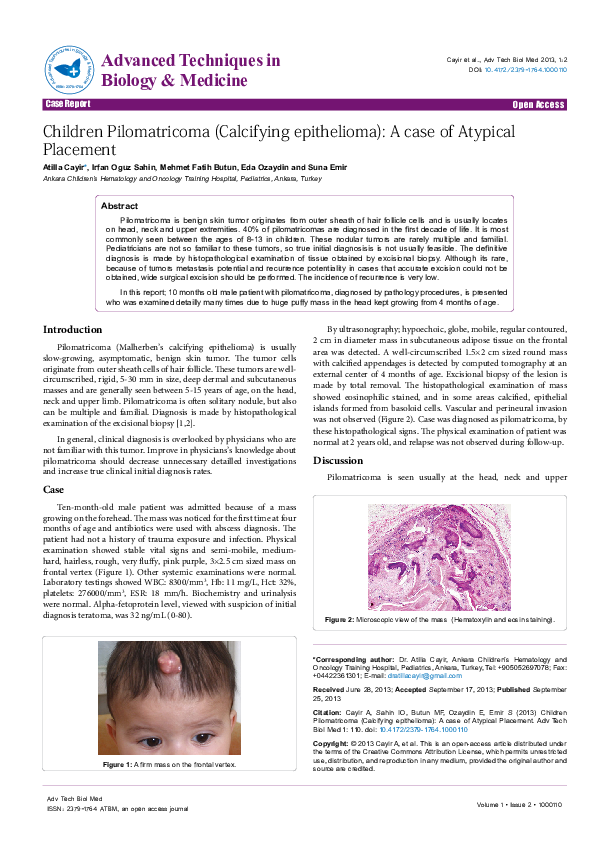 (PDF) Children Pilomatricoma (Calcifying epithelioma): A case of ...