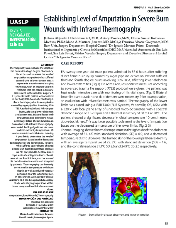 (PDF) Establishing Level of Amputation in Severe Burn Wounds with ...