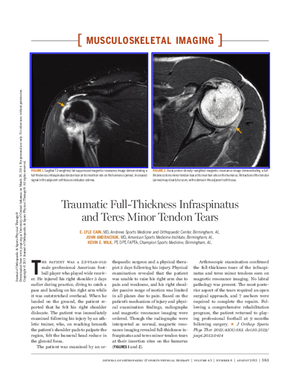 (PDF) Traumatic Full-Thickness Infraspinatus and Teres Minor Tendon Tears