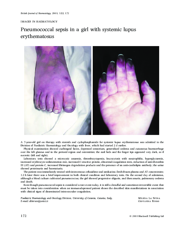 (PDF) Pneumococcal sepsis in a girl with systemic lupus erythematosus
