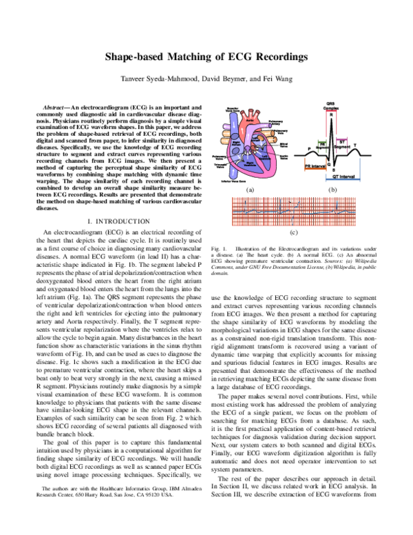 (PDF) Shape-based Matching of ECG Recordings