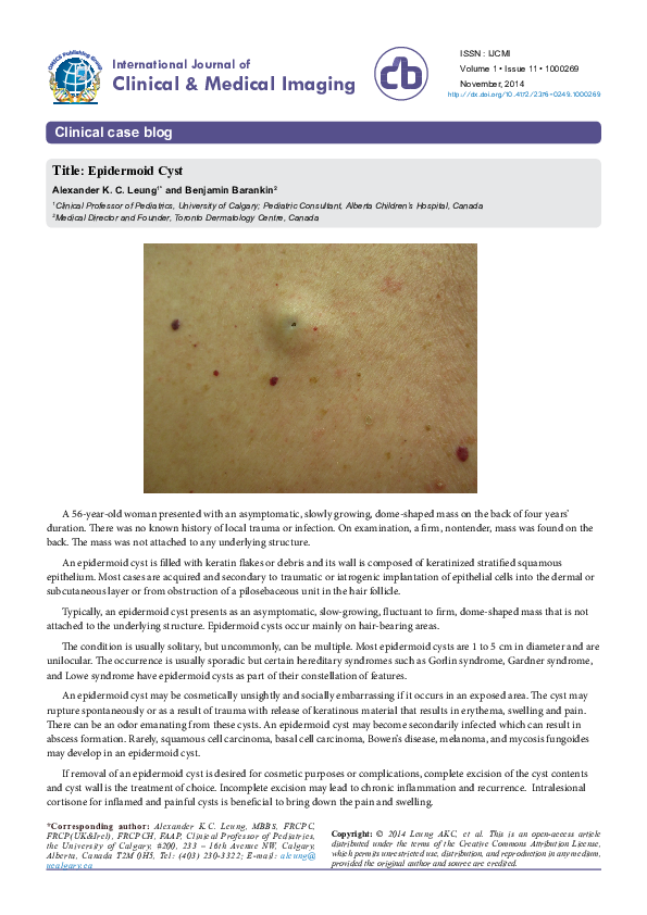 (PDF) Epidermoid Cyst