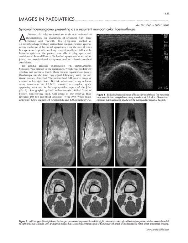 (PDF) Synovial haemangioma presenting as a recurrent monoarticular ...